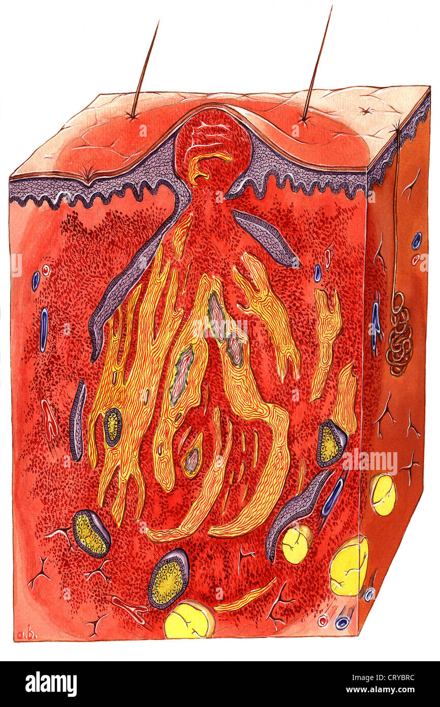 Acne Drawing High Resolution Stock Photography and Images - Alamy