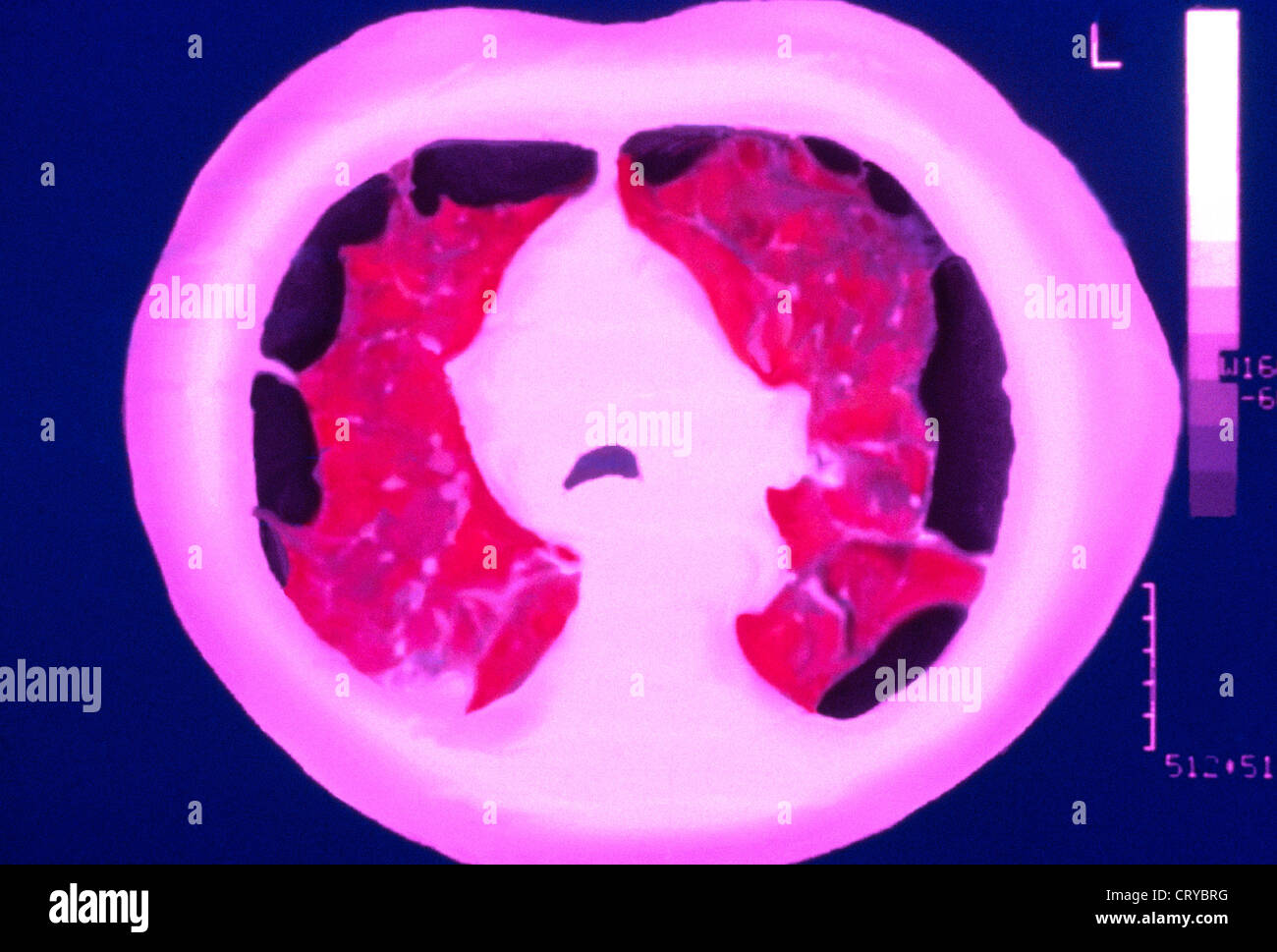 BULLOUS EMPHYSEMA, LUNG SCAN Stock Photo - Alamy