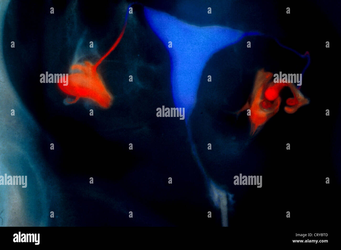 Hysterography hi-res stock photography and images - Alamy