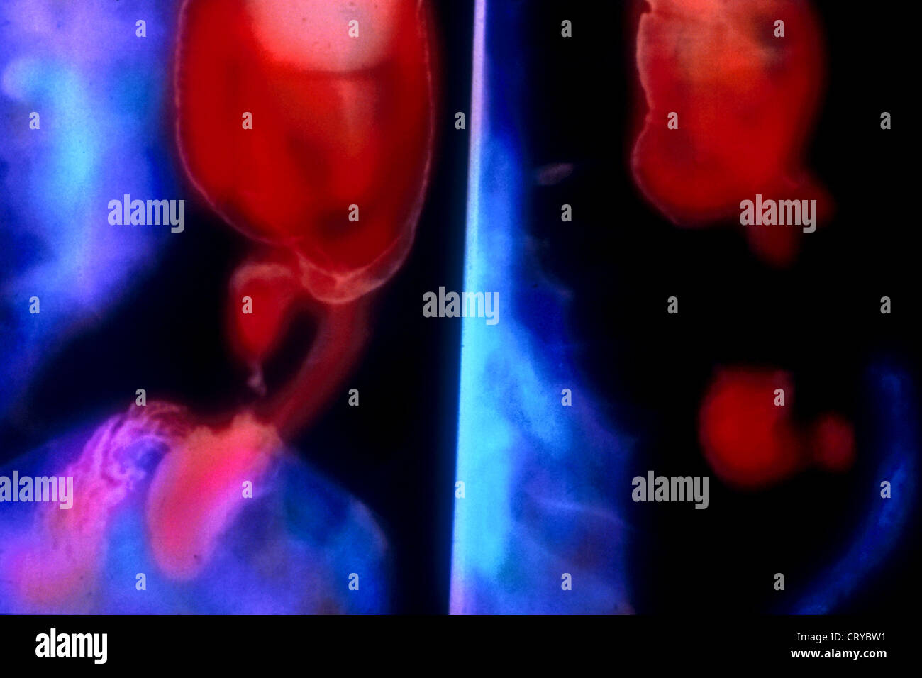 IMPACTION OF THE BOWEL, X-RAY Stock Photo - Alamy