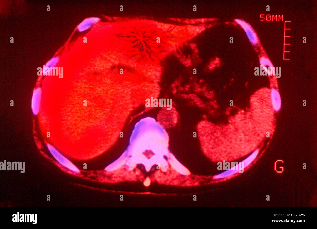 Liver Cancer Scan High Resolution Stock Photography and Images - Alamy
