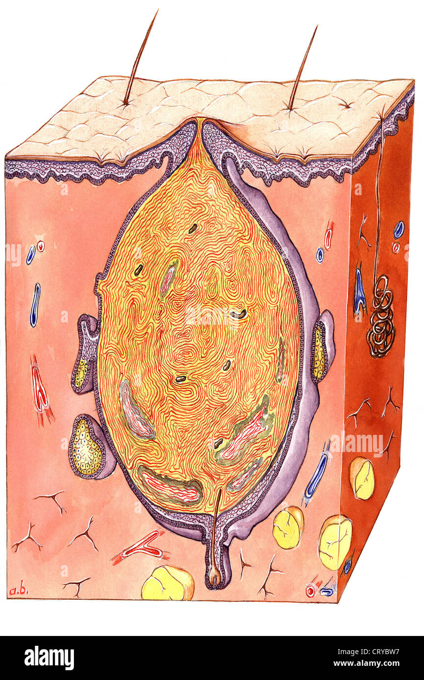 Acne Drawing High Resolution Stock Photography and Images - Alamy