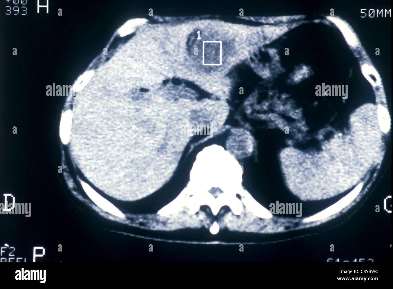 Liver scan hi-res stock photography and images - Alamy