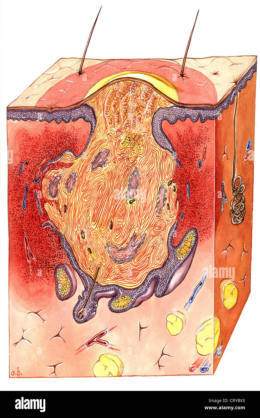 Acne drawing hi-res stock photography and images - Alamy