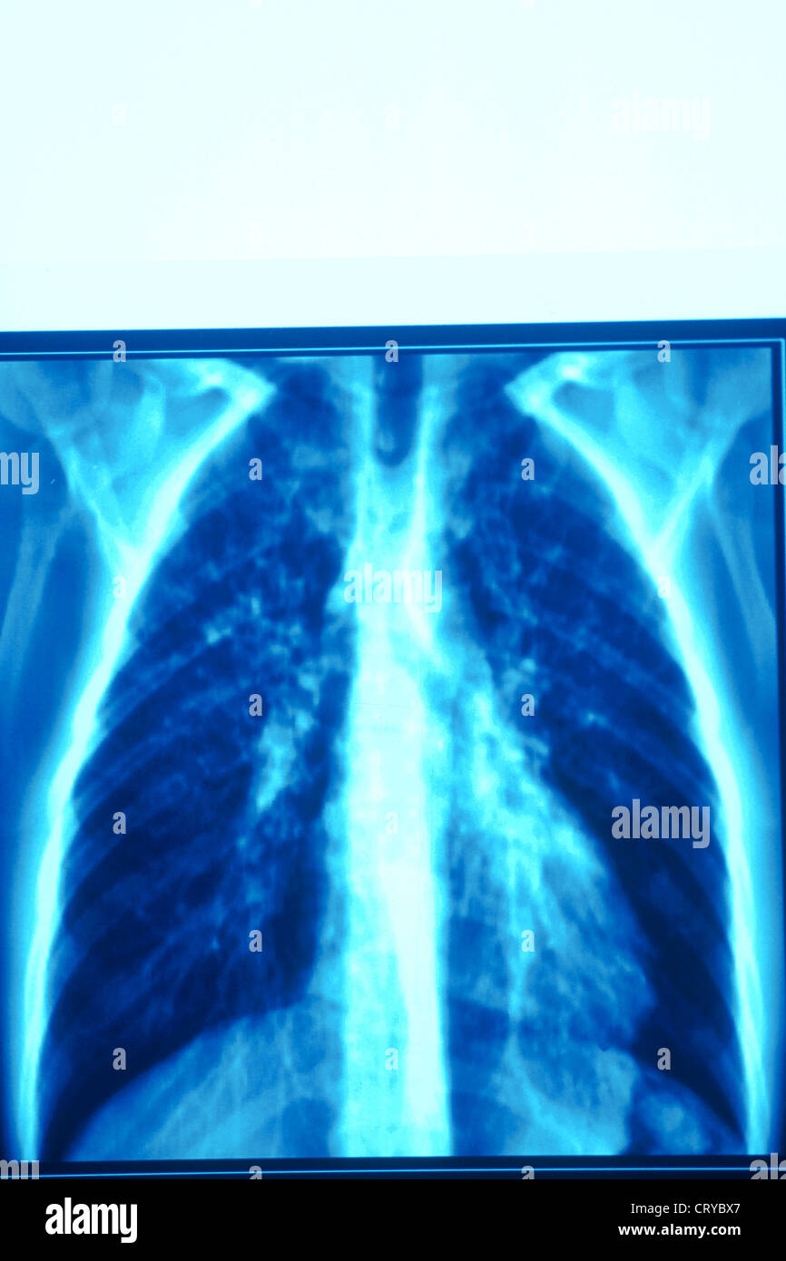 Bronchiectasis Stock Photos & Bronchiectasis Stock Images - Alamy