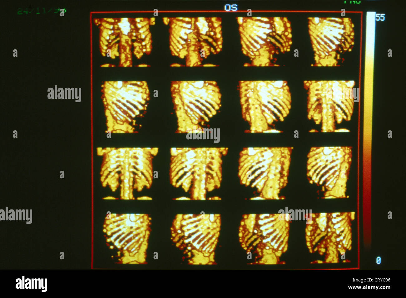 Scintiscanner Stock Photos & Scintiscanner Stock Images - Alamy