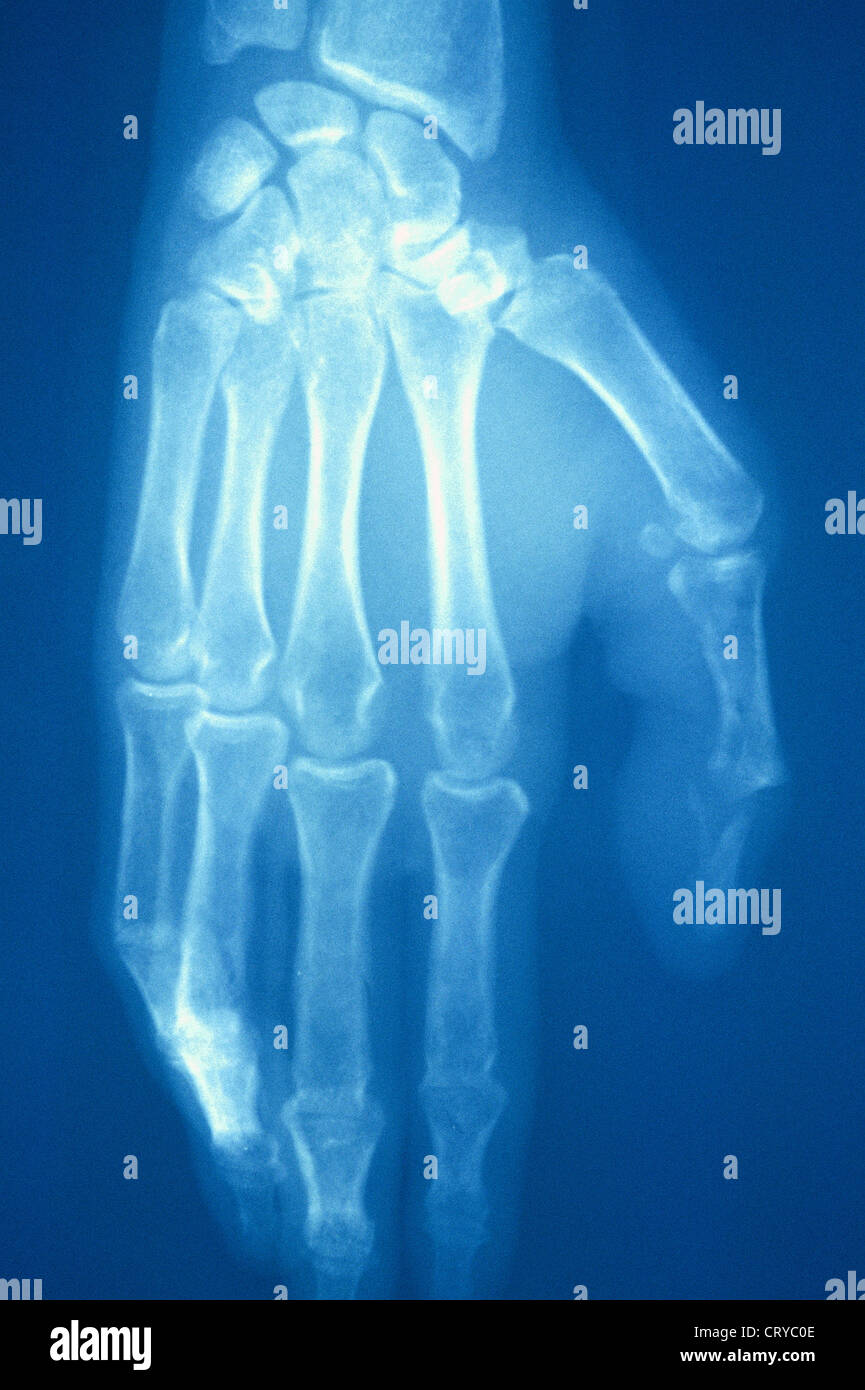 FRACTURED HAND, X-RAY Stock Photo - Alamy