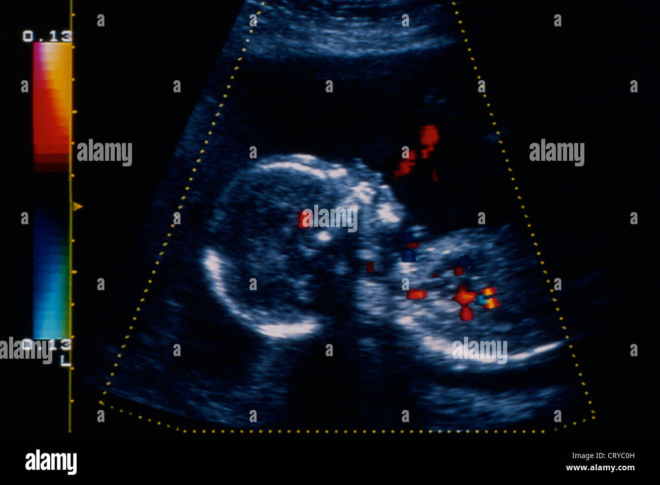 ULTRASOUND BIOMETRY OF THE FETUS Stock Photo - Alamy