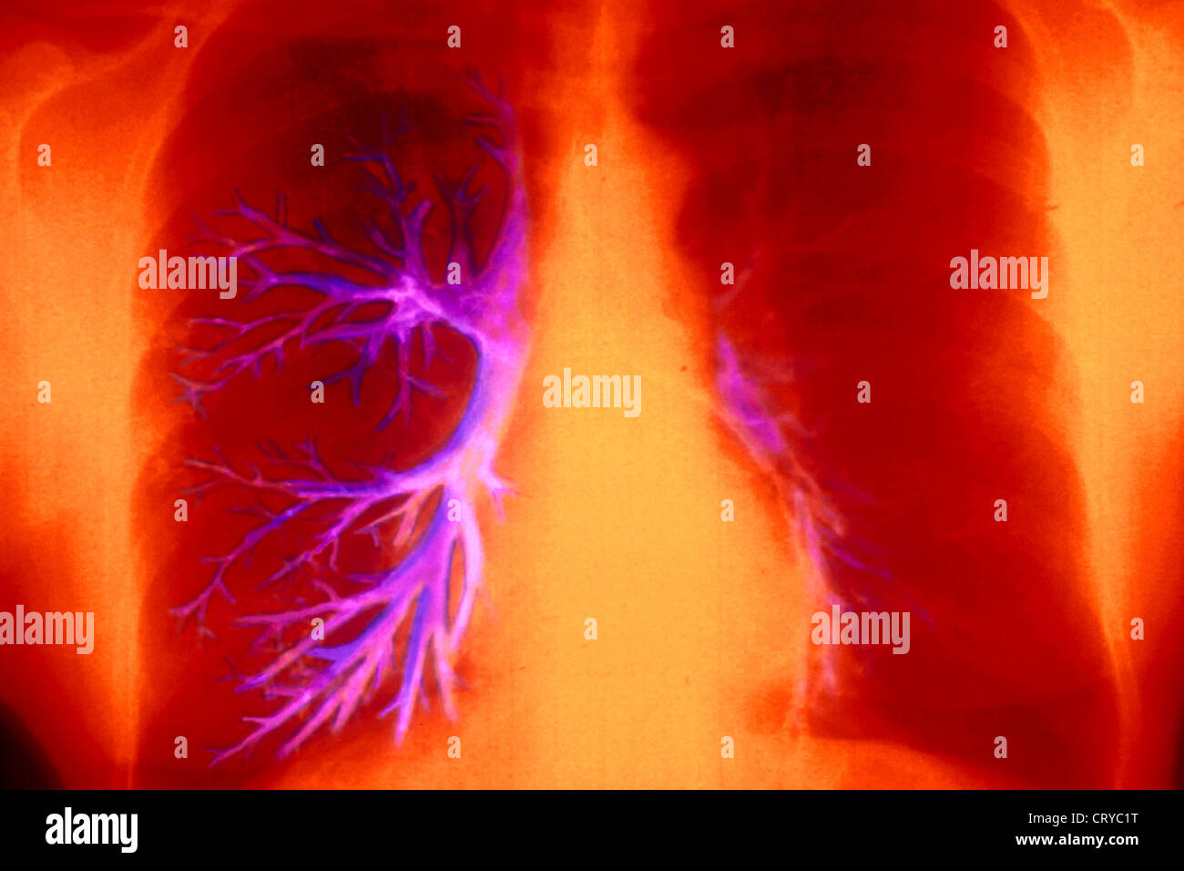 Bronchiectasis Stock Photos & Bronchiectasis Stock Images - Alamy