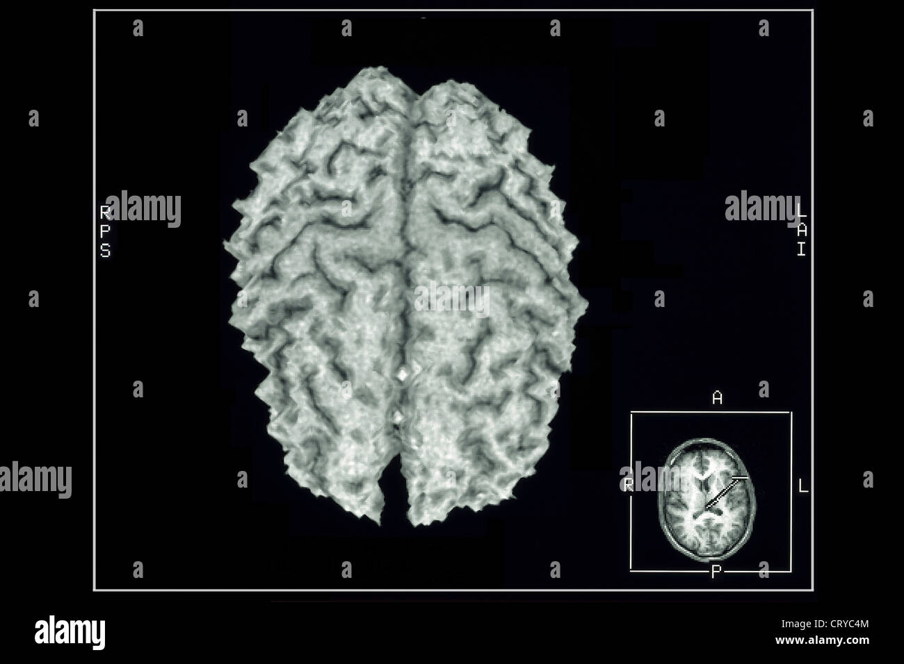 CEREBRAL CORTEX, MRI Stock Photo - Alamy