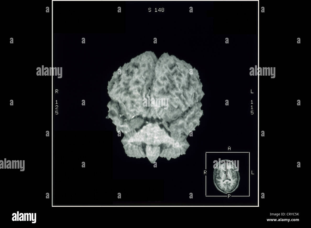 CEREBRAL CORTEX, MRI Stock Photo - Alamy