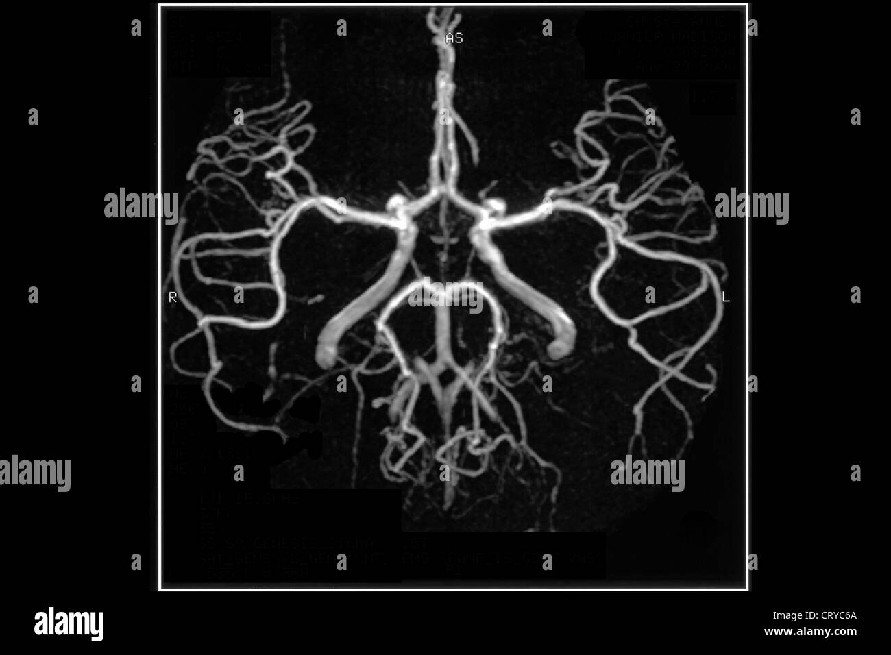 Posterior cerebral artery hi-res stock photography and images - Alamy