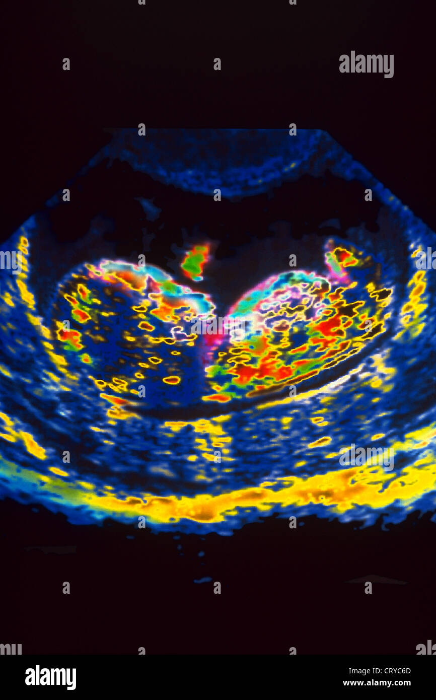 ULTRASOUND BIOMETRY OF THE FETUS Stock Photo - Alamy