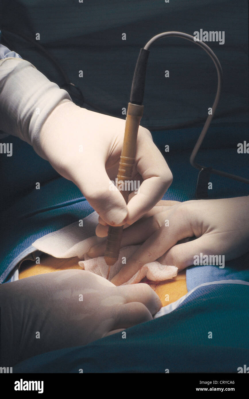 Cauterization hi-res stock photography and images - Alamy