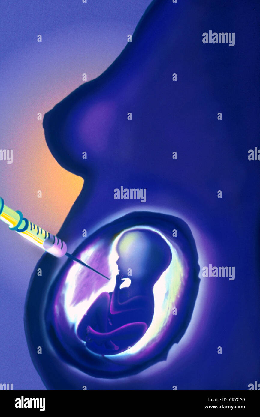 Amniocentesis test hi-res stock photography and images - Alamy