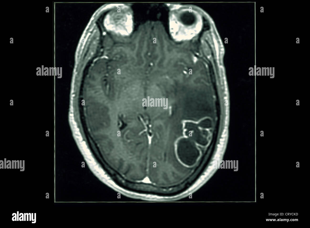 Brain abscesses hi-res stock photography and images - Alamy