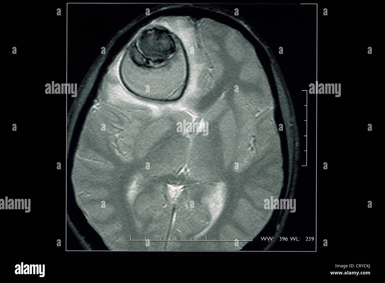 CYST IN THE BRAIN, MRI Stock Photo - Alamy