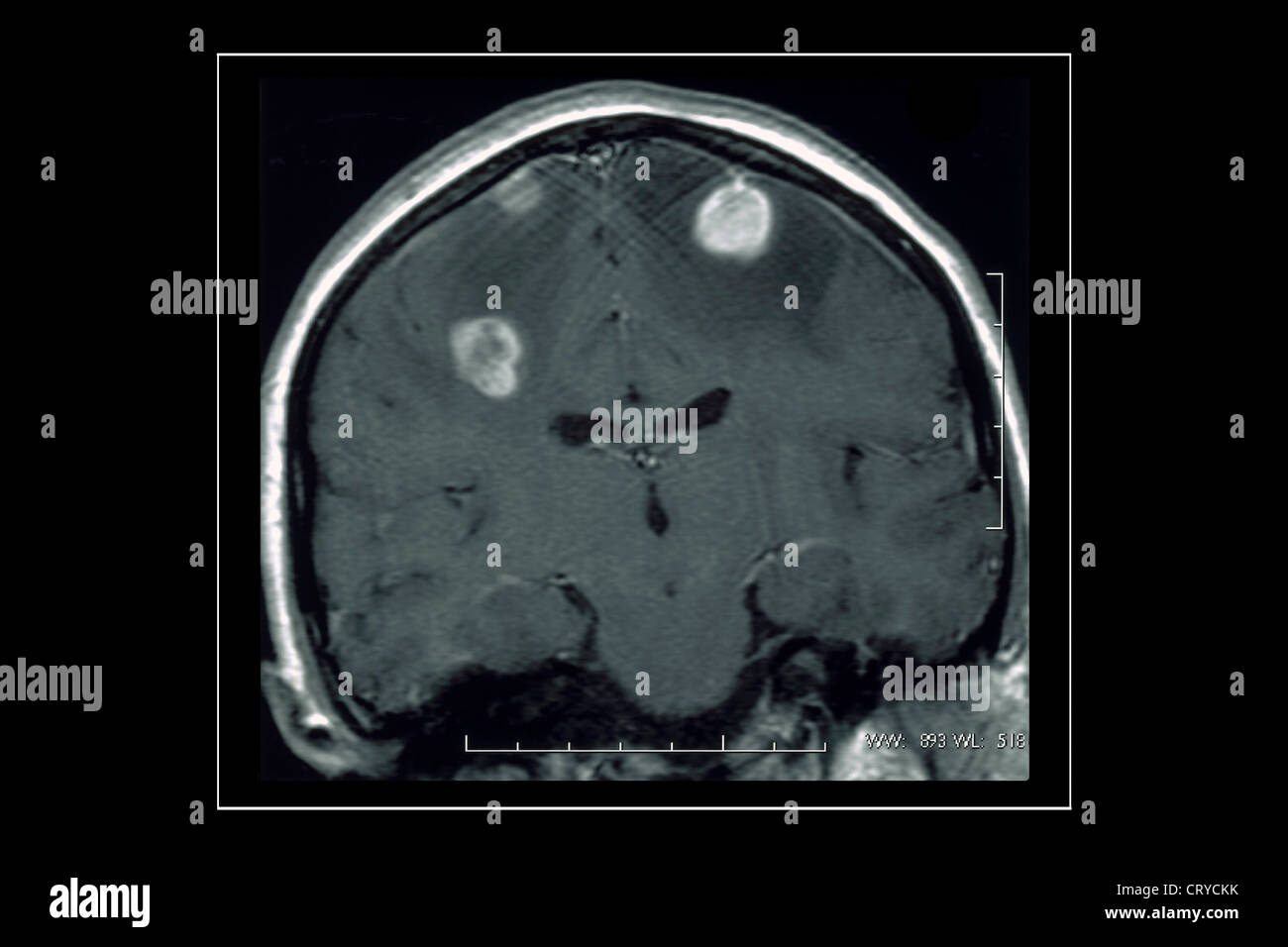 METASTASIS IN THE BRAIN, MRI Stock Photo - Alamy