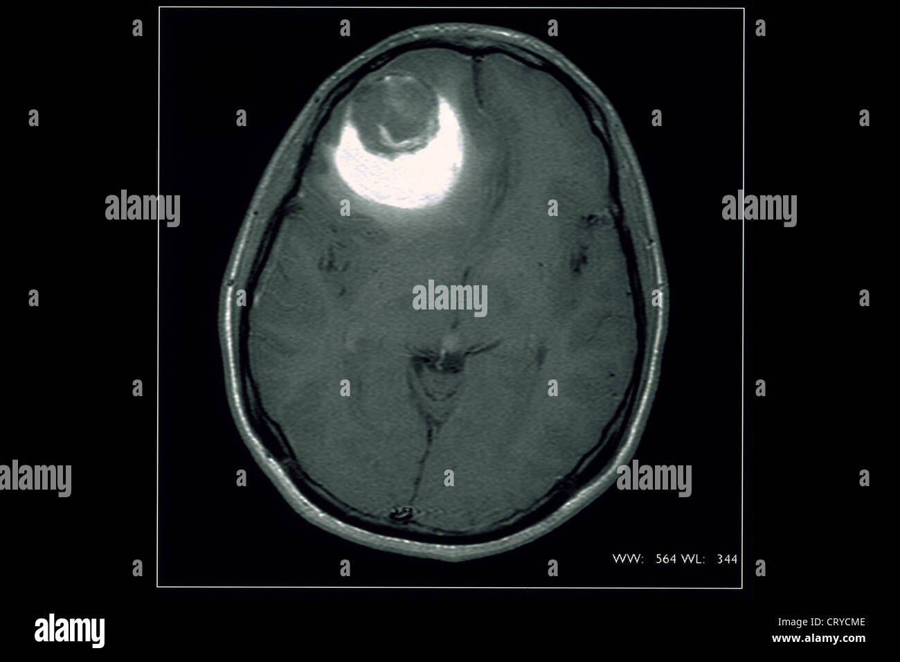 Benign brain mri hi-res stock photography and images - Alamy