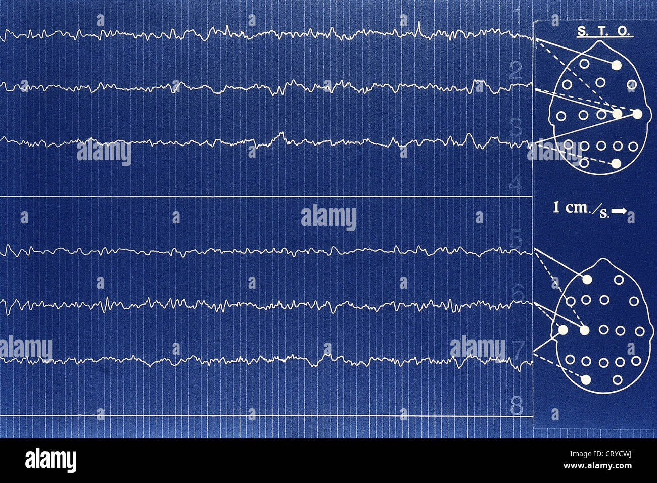 EEG EXAMINATION OF AN INFANT Stock Photo - Alamy