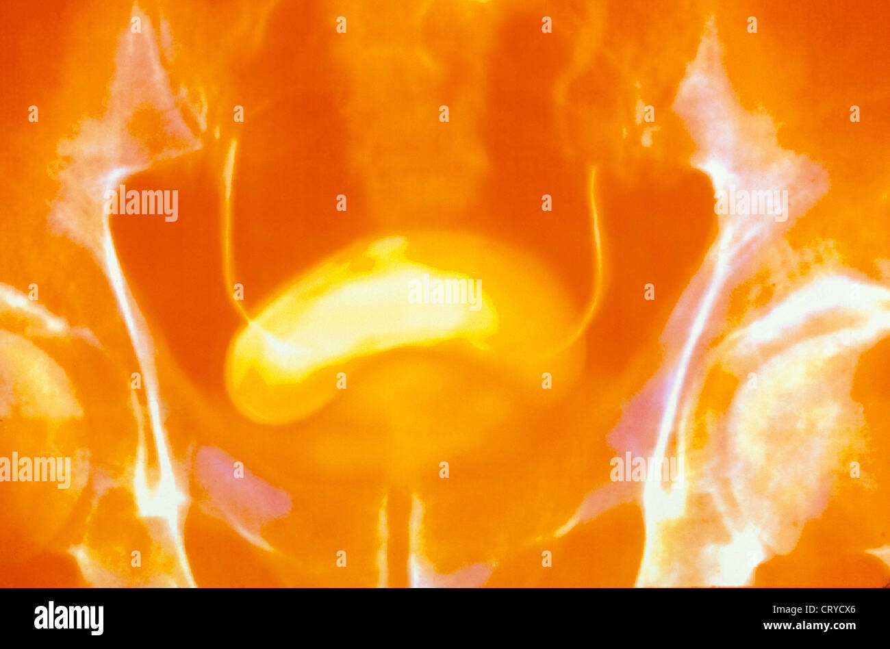 PROSTATIC ADENOMA, X-RAY Stock Photo - Alamy