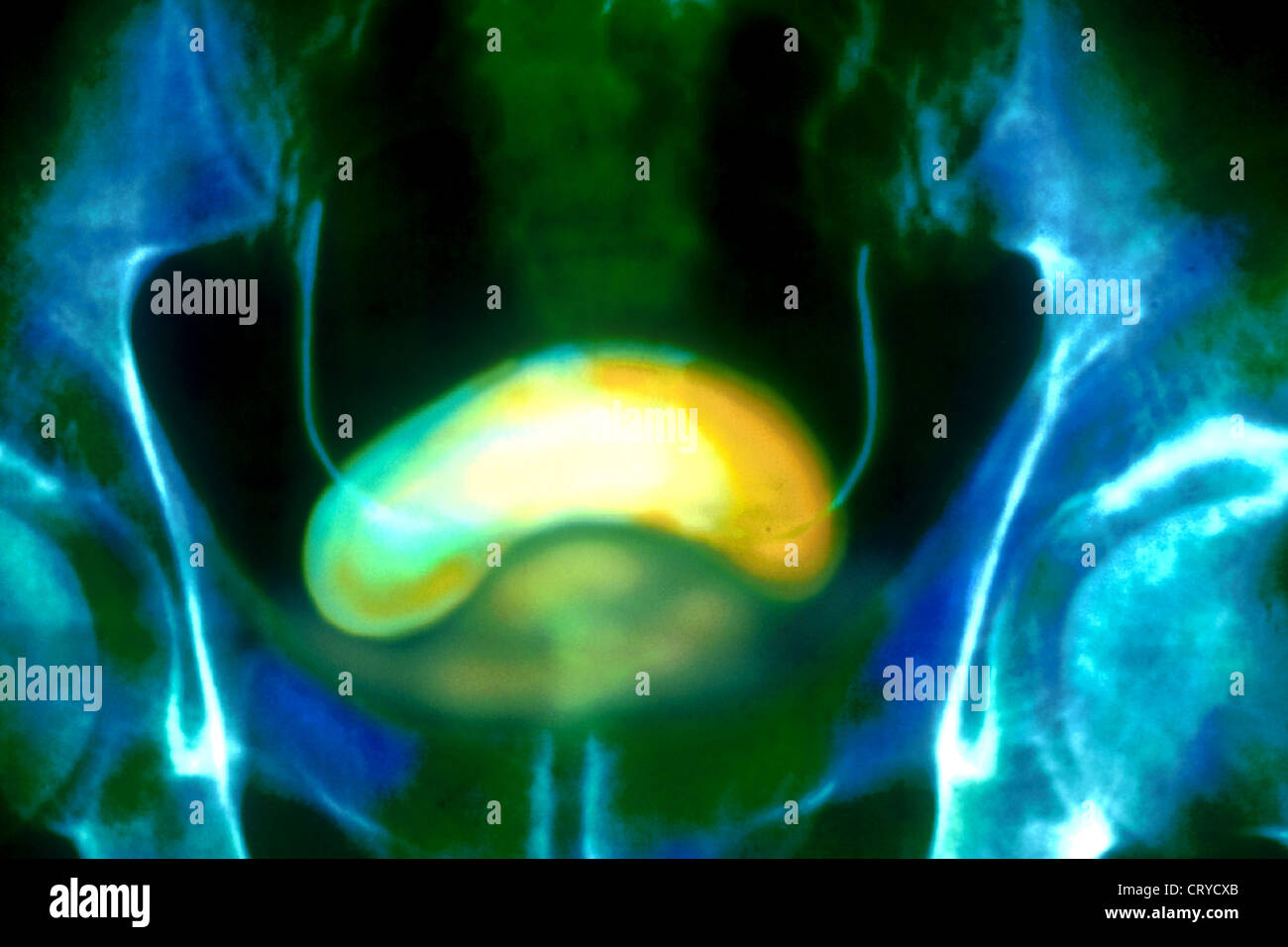 PROSTATIC ADENOMA, X-RAY Stock Photo - Alamy