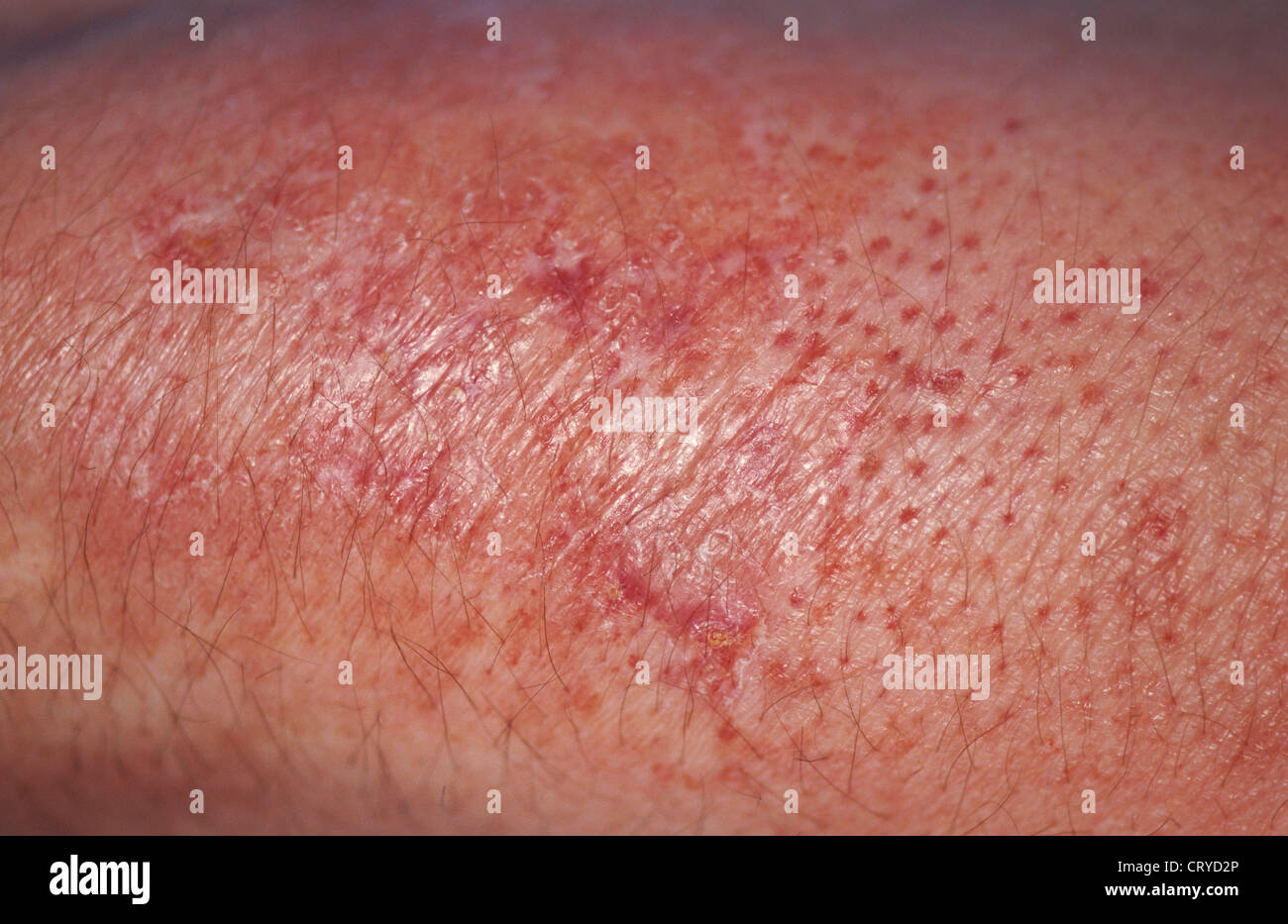 Dermatomyositis hi-res stock photography and images - Alamy