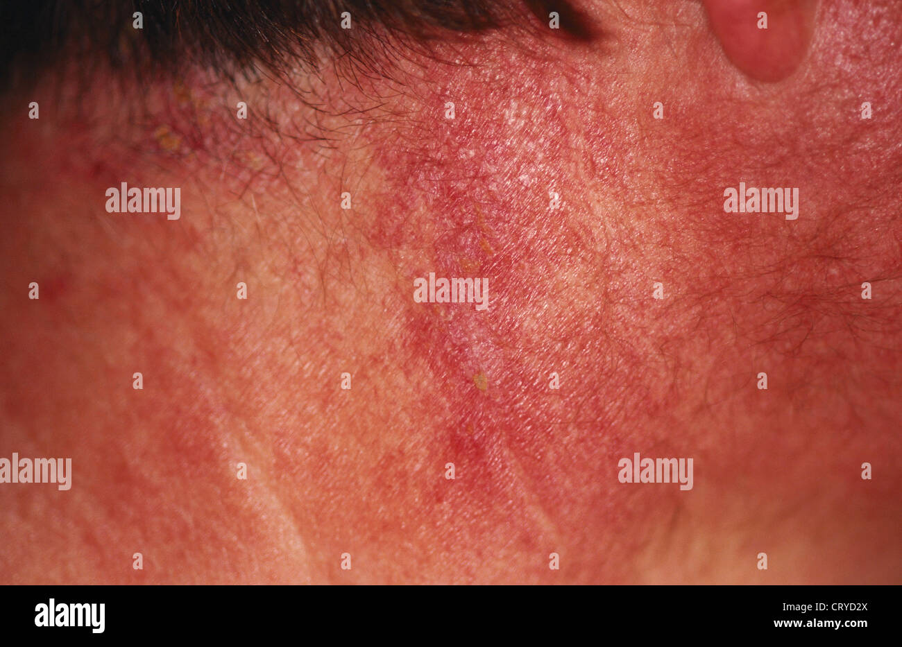 DERMATOMYOSITIS Stock Photo - Alamy
