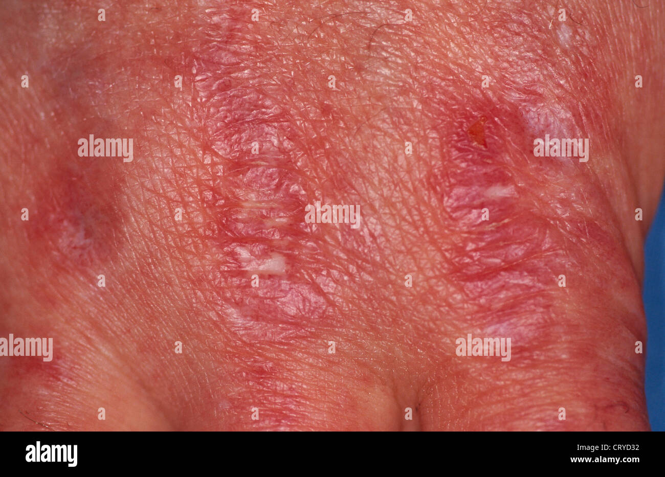 Dermatomyositis hi-res stock photography and images - Alamy