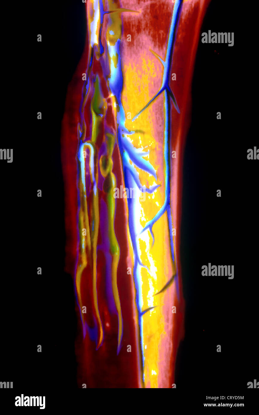 Phlebography hi-res stock photography and images - Alamy