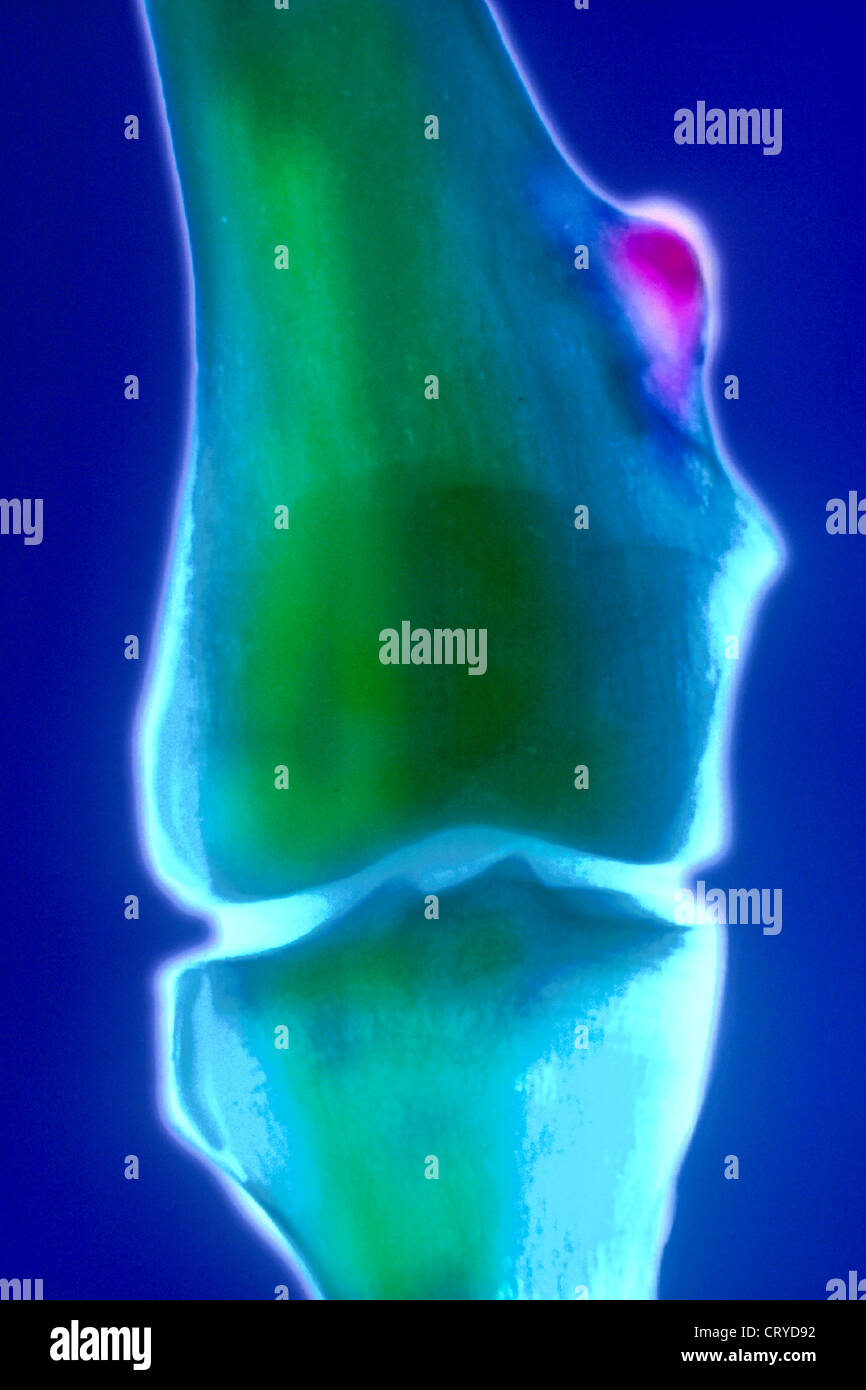 Exostosis hi-res stock photography and images - Alamy