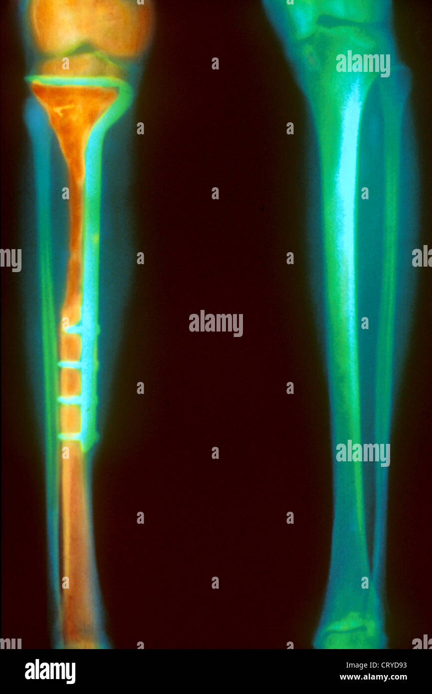 ANGIOMA ON A BONE, X-RAY Stock Photo - Alamy