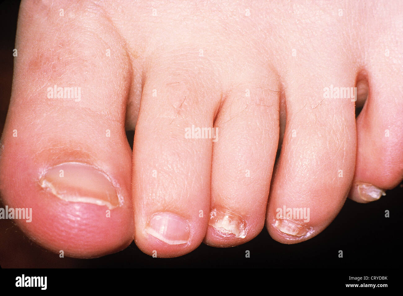 MYCOSIS ON A FOOT Stock Photo - Alamy