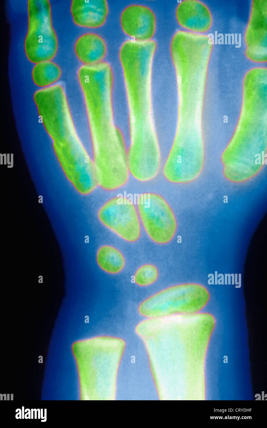 Child hand x ray hi-res stock photography and images - Alamy