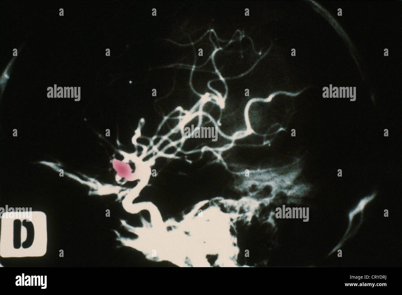 ANEURYSM OF THE BRAIN, ANGIOGR Stock Photo - Alamy