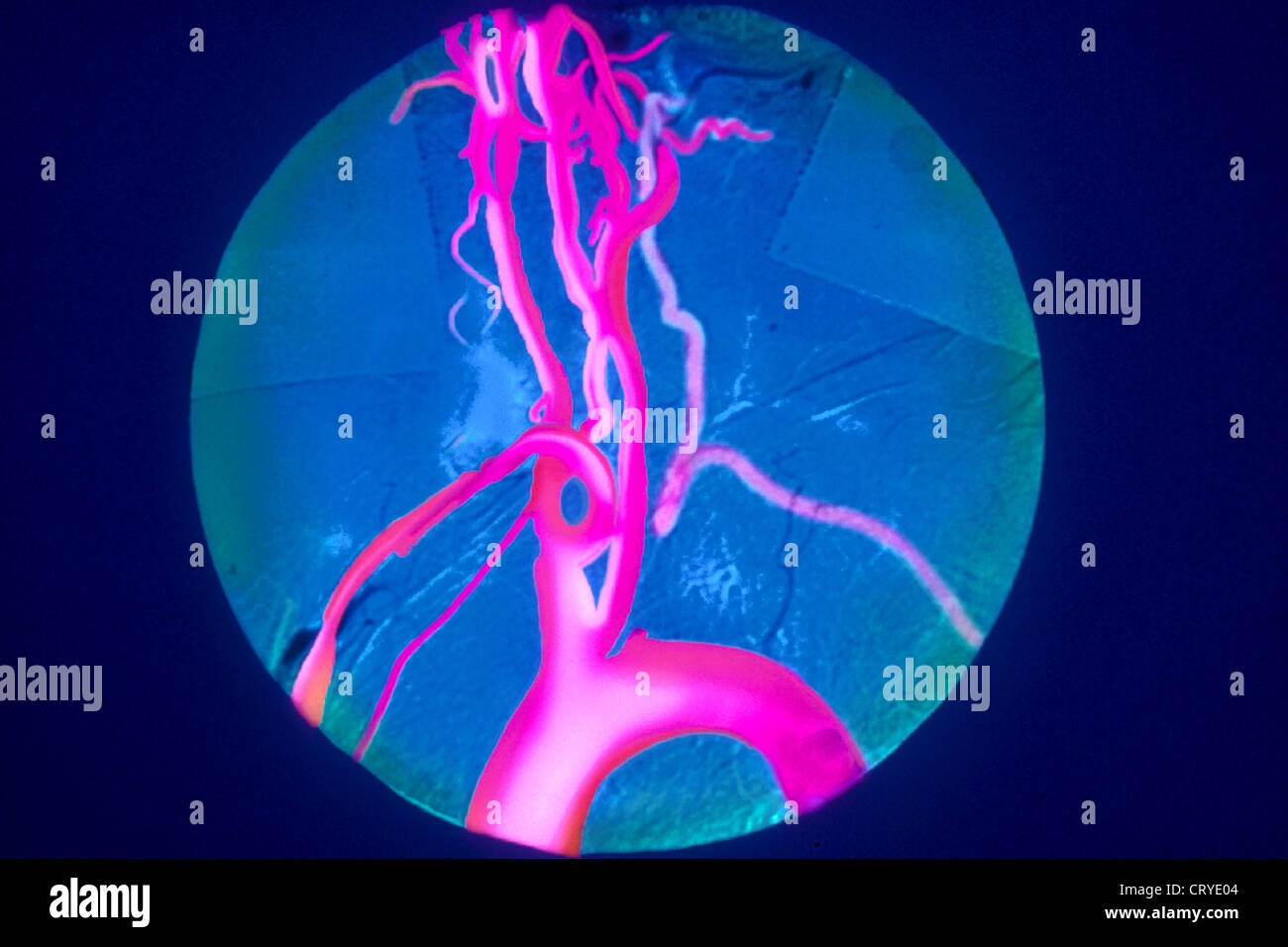 Arterial thrombosis hi-res stock photography and images - Alamy