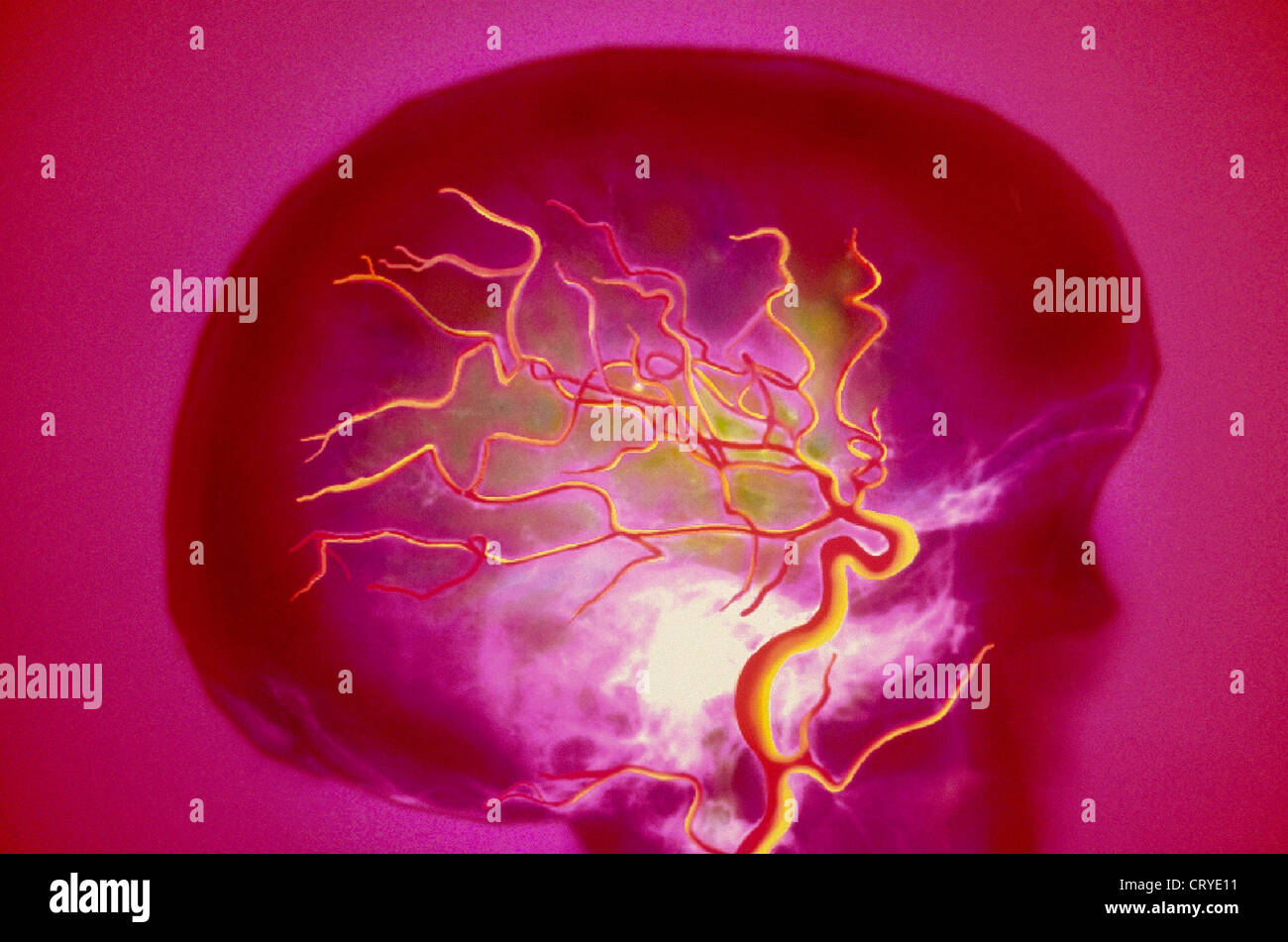 Arteria cerebral hi-res stock photography and images - Alamy