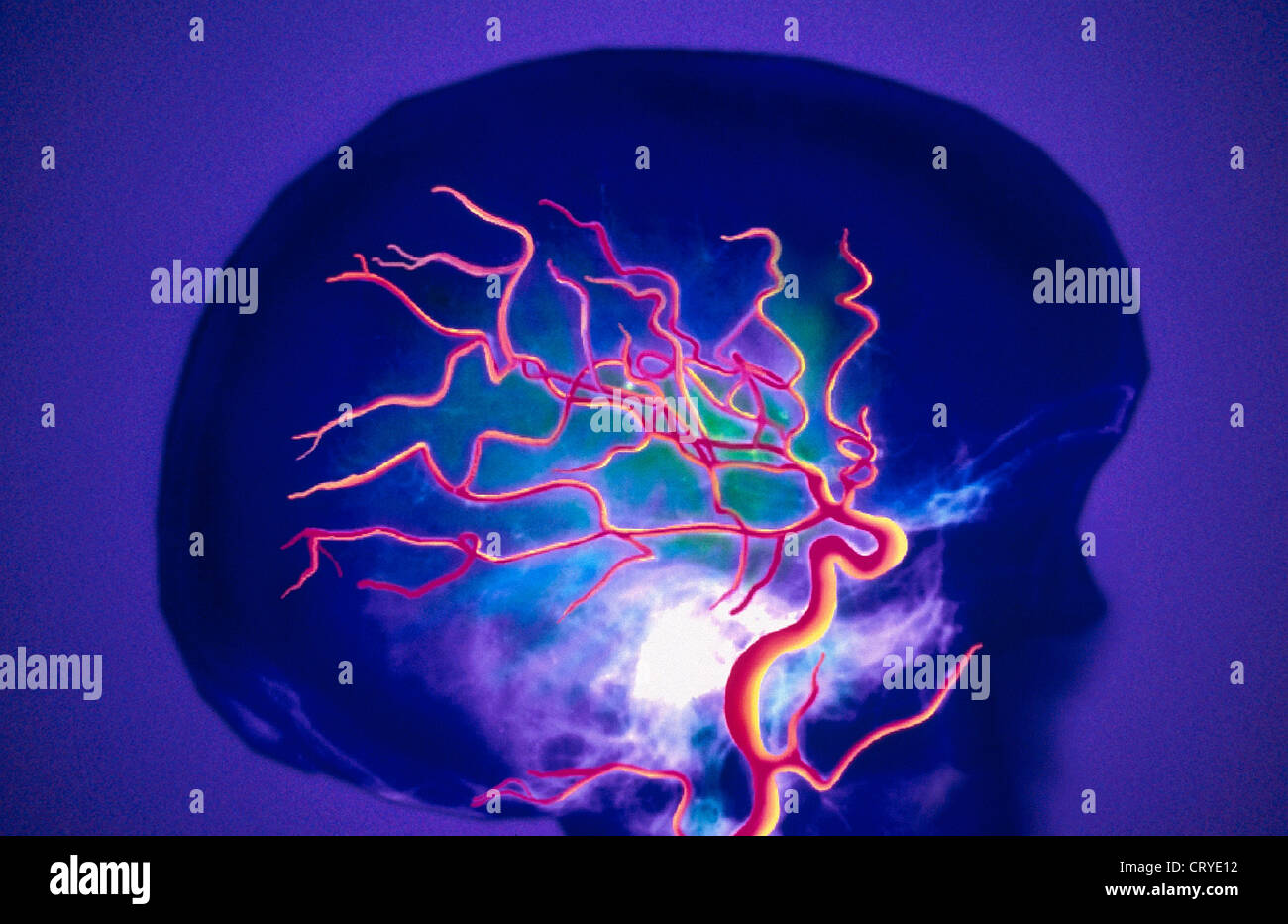 Cerebral arteriography hi-res stock photography and images - Alamy