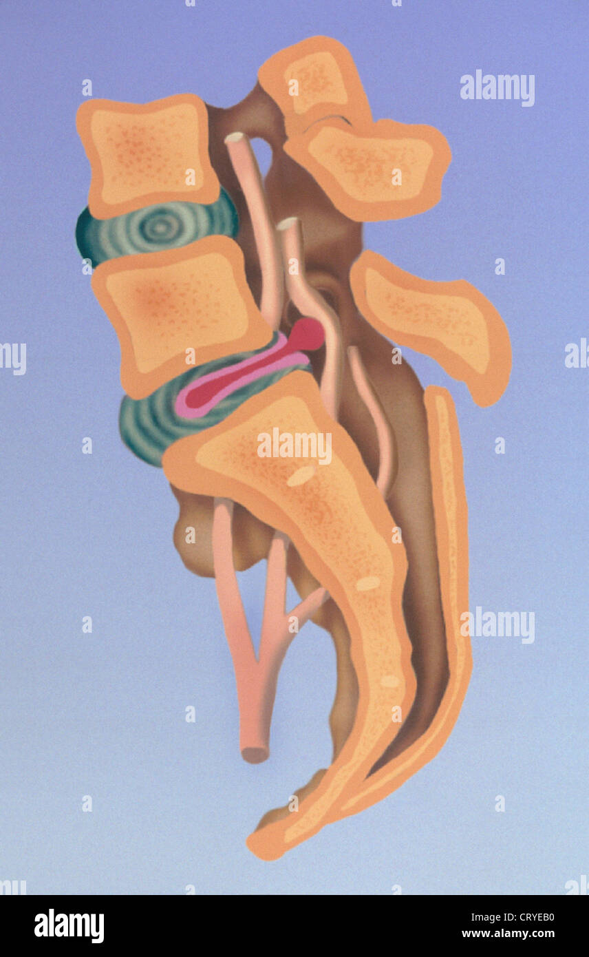 Lumbar disk herniation hi-res stock photography and images - Alamy