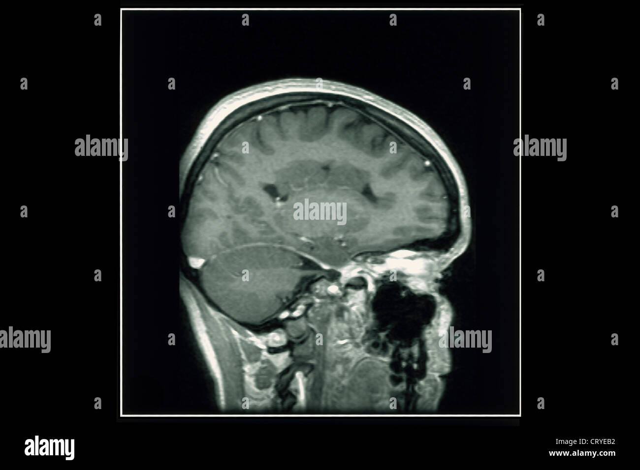 Epilepsy scan mri hi-res stock photography and images - Alamy