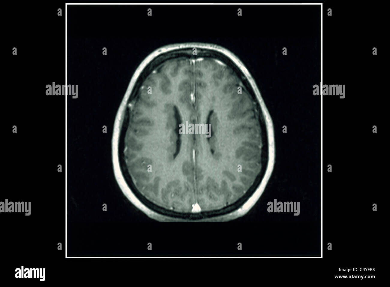 Epilepsy Scan High Resolution Stock Photography and Images - Alamy