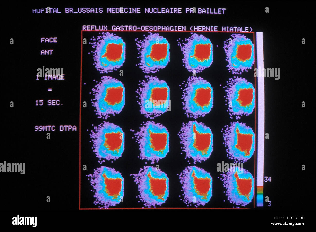 Scintigram hi-res stock photography and images - Alamy