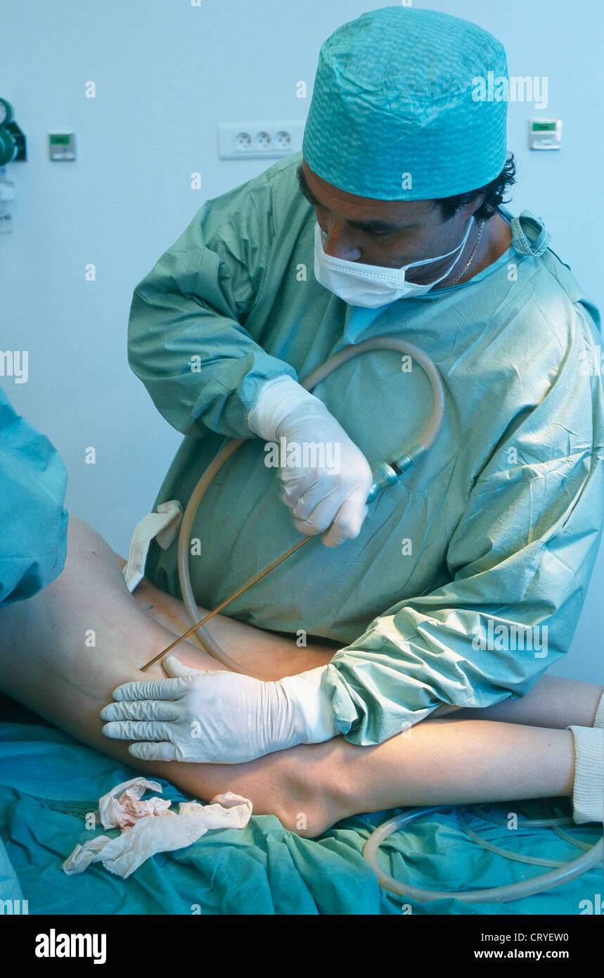 Fat suction woman hi-res stock photography and images - Alamy