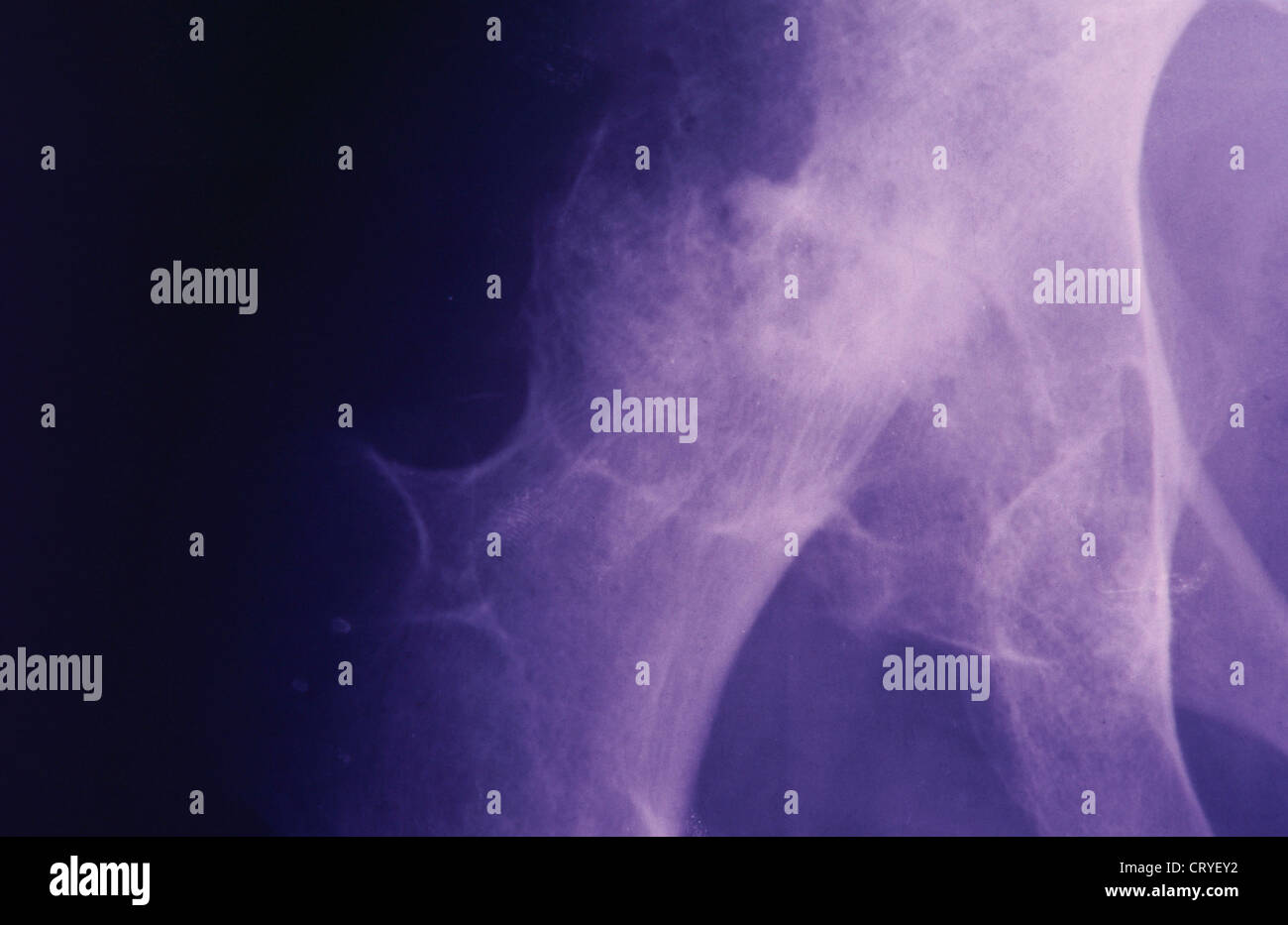 TUBERCULOSIS IN THE BONES, X-RAY Stock Photo - Alamy