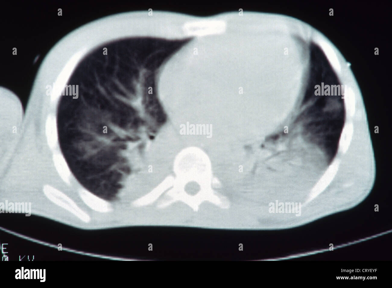 PNEUMOCOCCAL PNEUMONIA, SCAN Stock Photo - Alamy