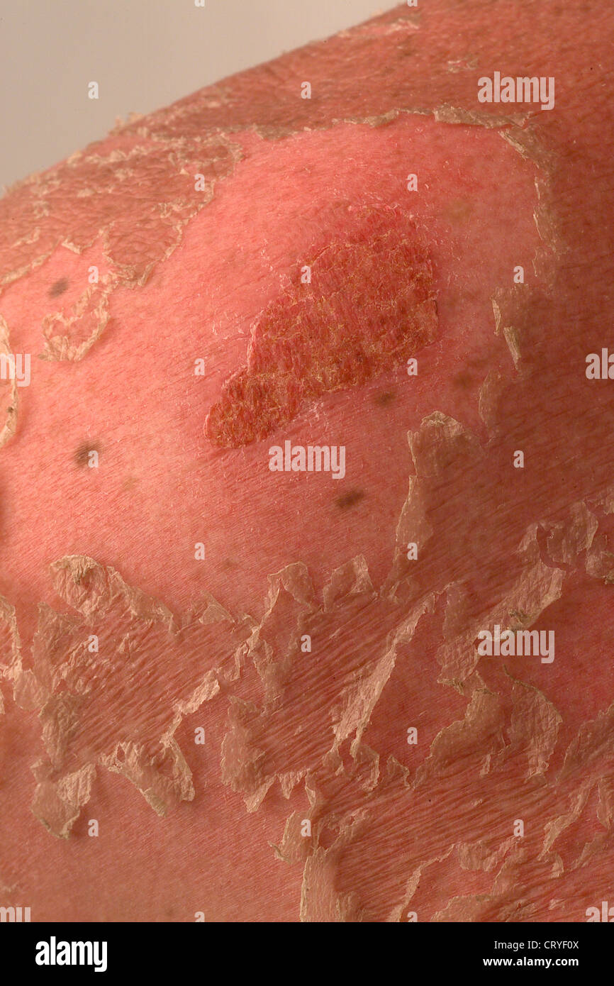 Solar erythema hi-res stock photography and images - Alamy