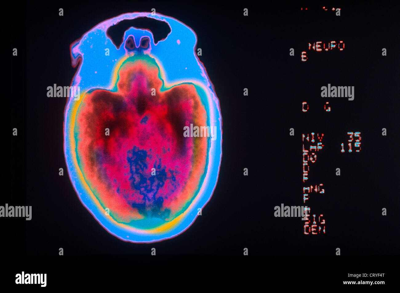 CHRONIC MENINGITIS, SCAN Stock Photo - Alamy