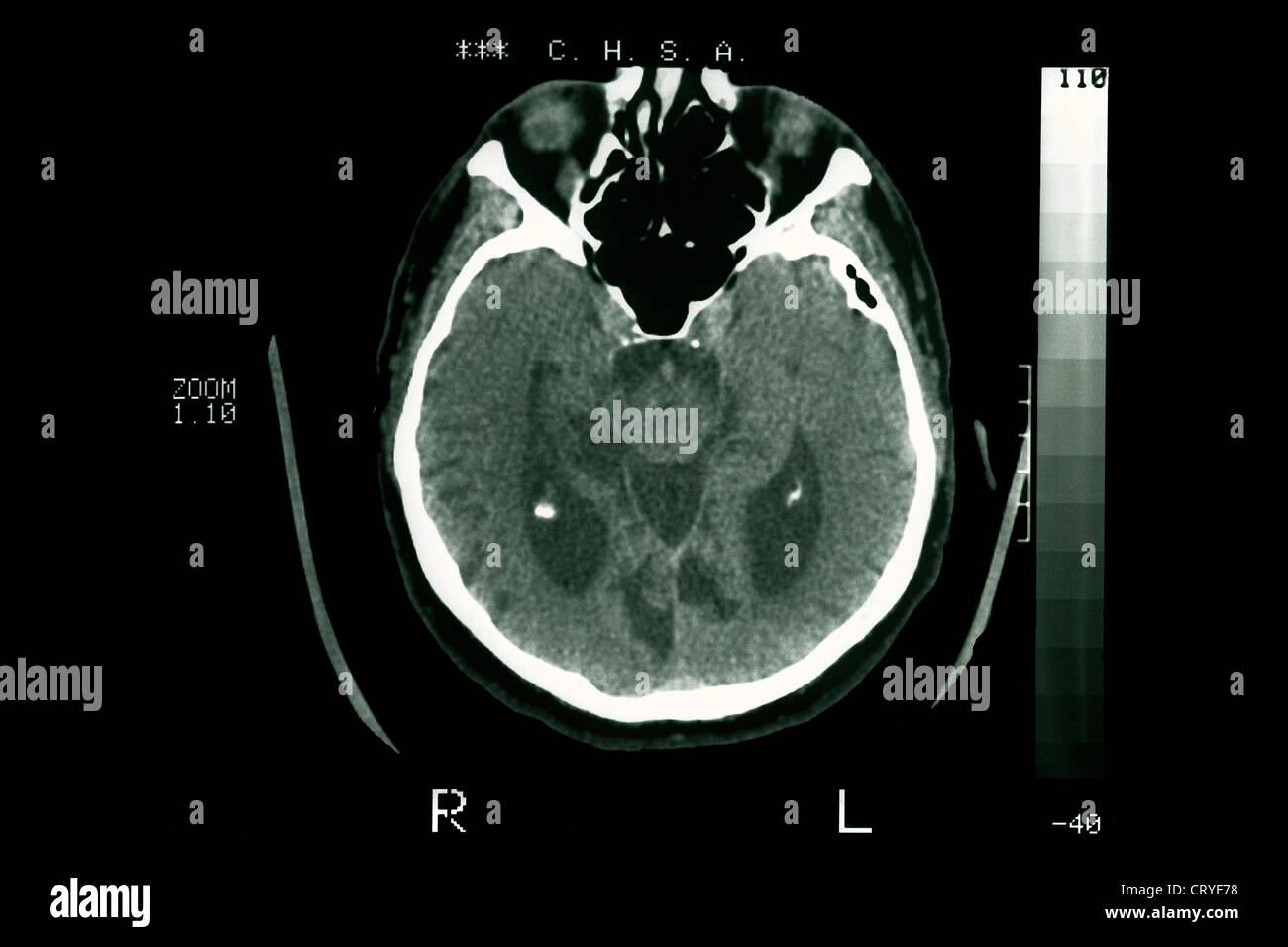 Alzheimer’s disease x ray hi-res stock photography and images - Alamy