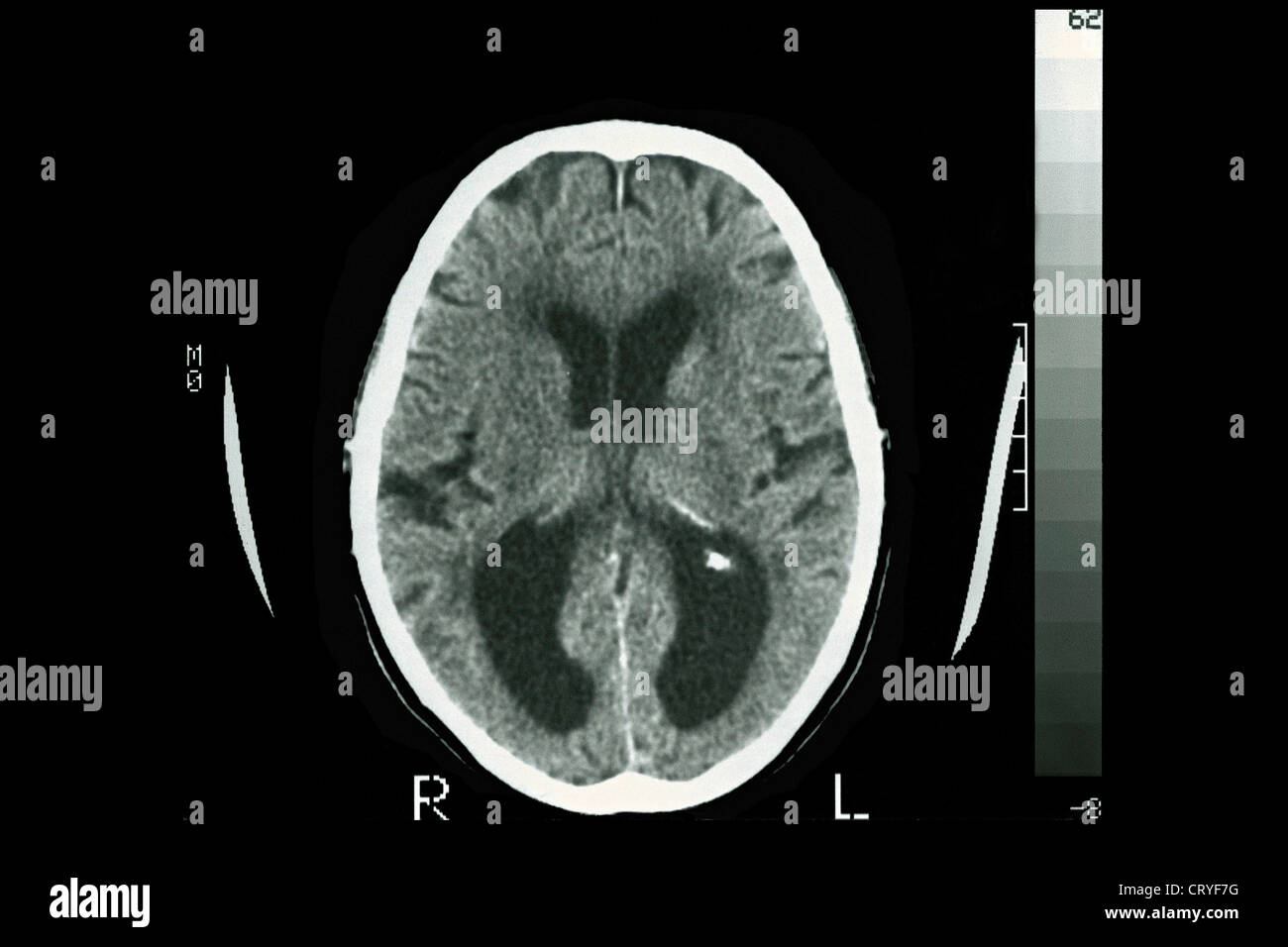 ALZHEIMER'S DISEASE, SCAN Stock Photo - Alamy