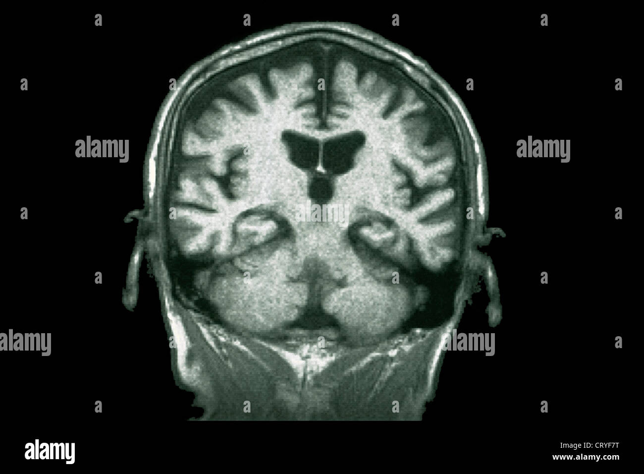 Mri scan brain memory hi-res stock photography and images - Alamy